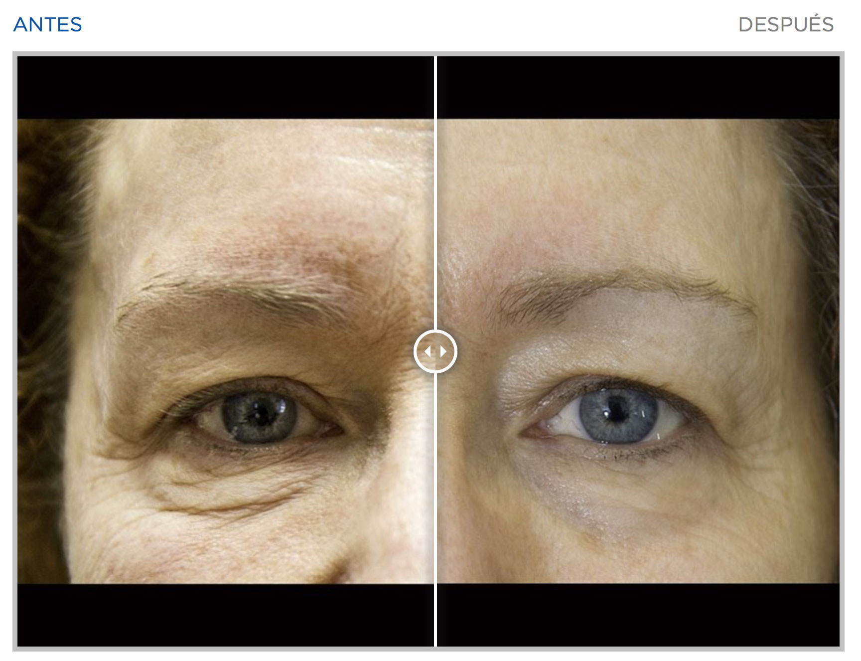 BTL Exilis Elite TM - medical radiofrequency and ultrasound ...